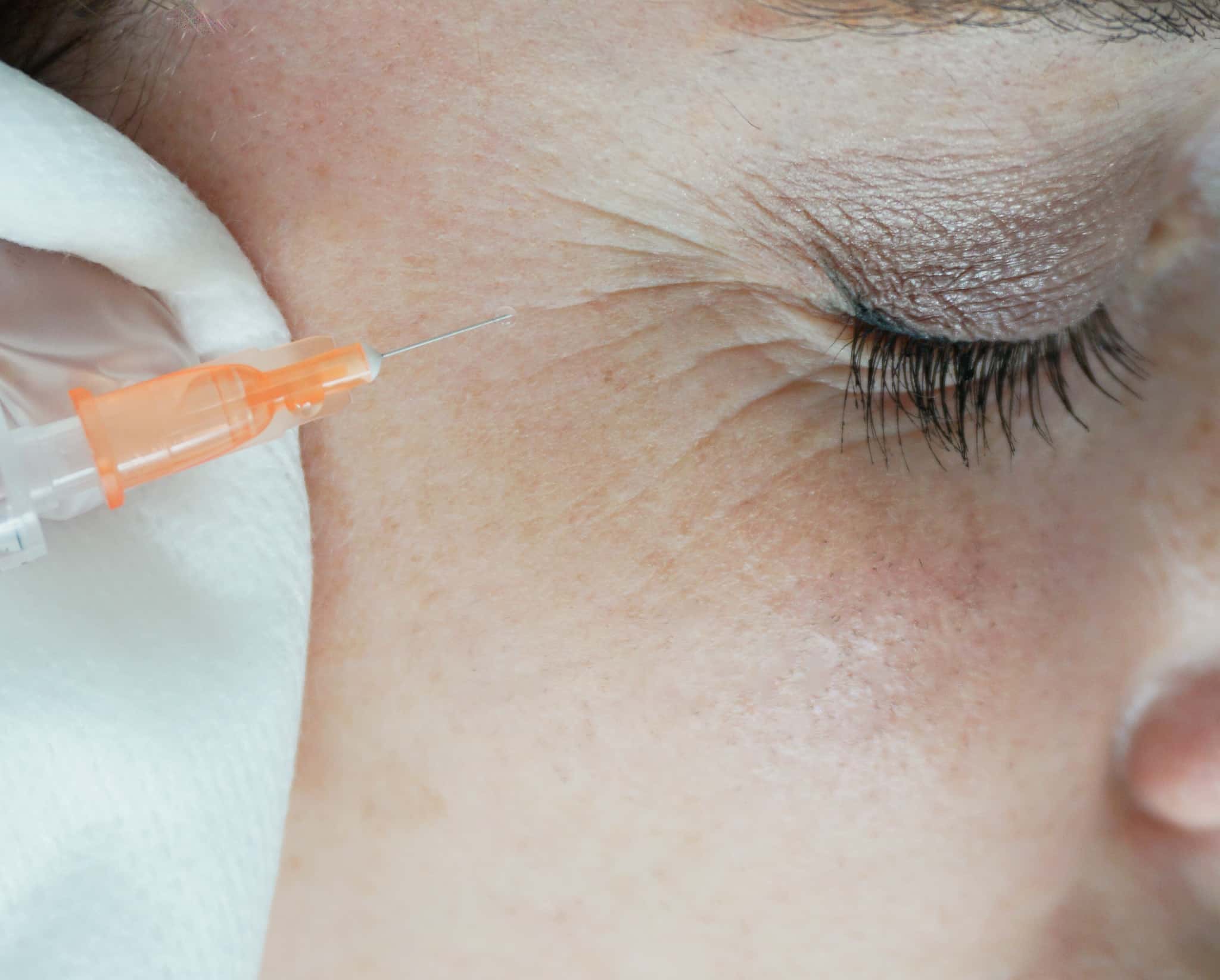 Traitements des Rides à Vannes | Clinique Esthétique Médicale